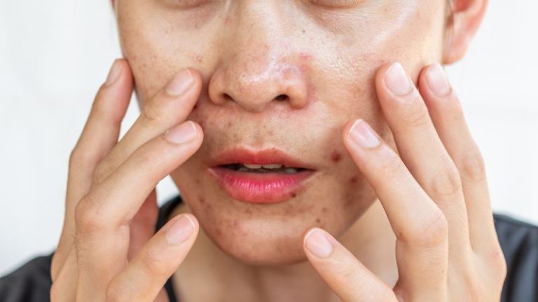 10+ Best Makeup Tips For Oily Skin In Summer to Stay Fresh